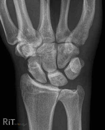 RiT radiology: Hook of Hamate Fracture