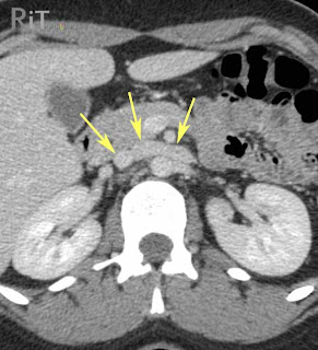 RiT radiology: Left Inferior Vena Cava (IVC)