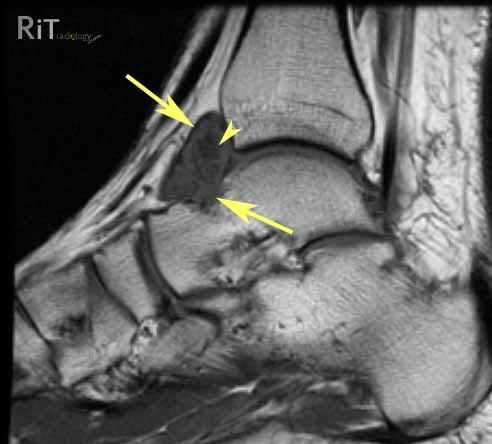 RiT radiology: Pigmented Villonodular Synovitis (PVNS) of the Ankle