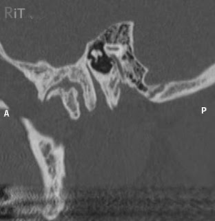 RiT radiology: Temporomandibular Osteoarthritis
