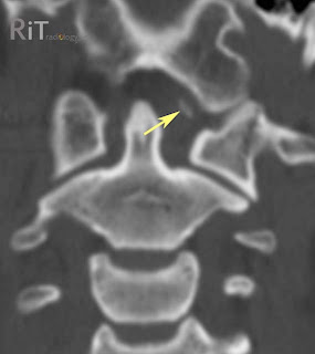 RiT radiology: Occipital Condylar Fracture