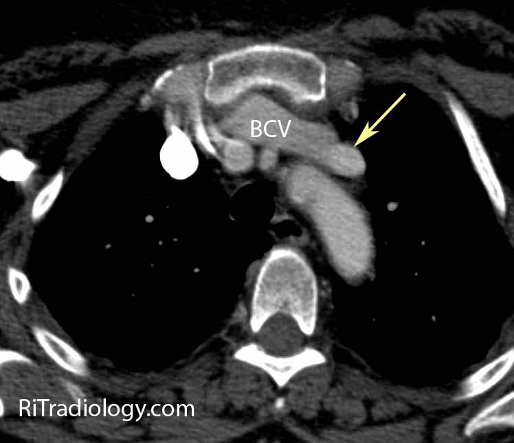 RiT radiology: Partial Anomalous Pulmonary Venous Return (PAPVR)