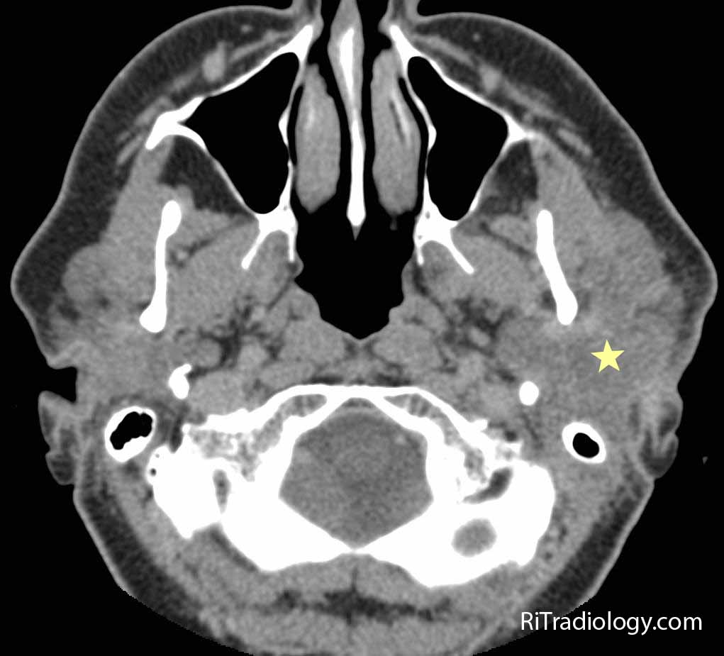 RiT radiology: Parotitis