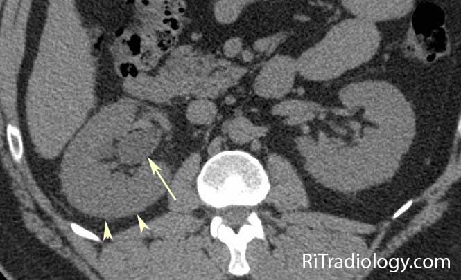 RiT radiology: Perinephric Stranding with Dilated Ureter