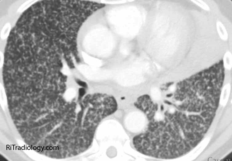 RiT radiology: Random Nodules