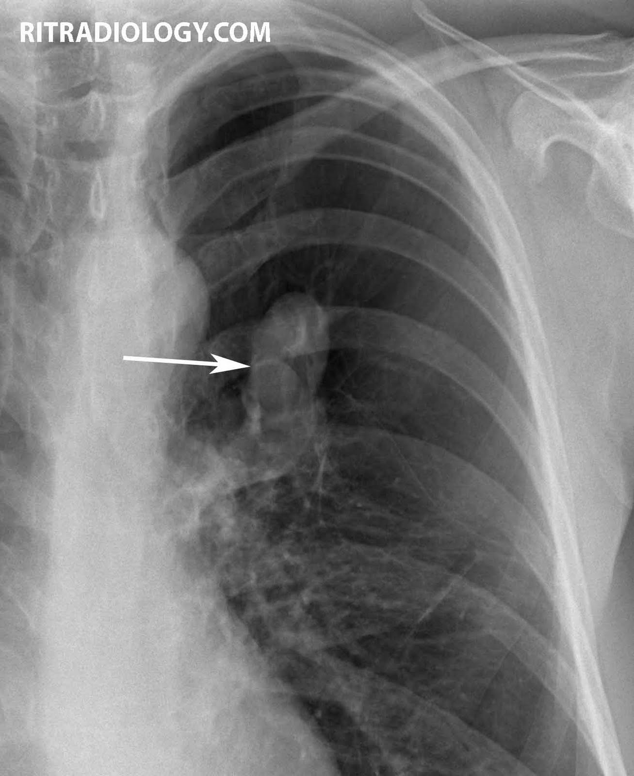 RiT radiology: Bronchial Atresia