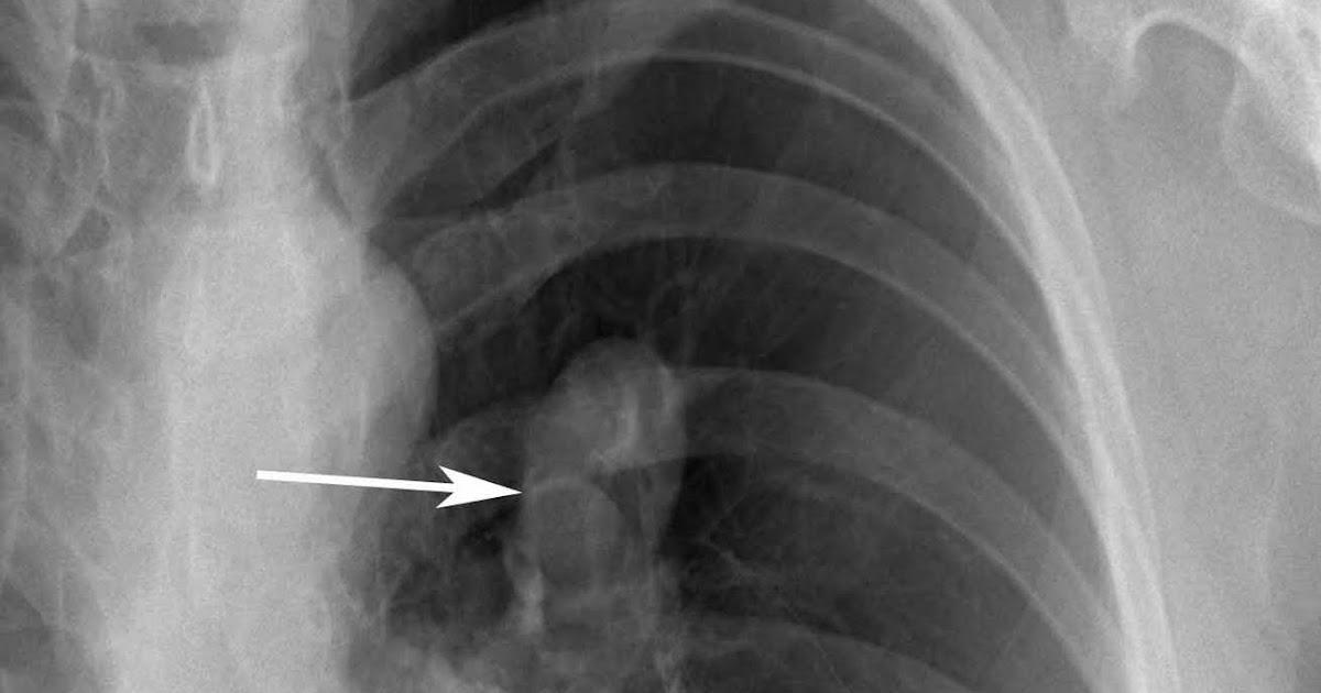 RiT radiology: Bronchial Atresia