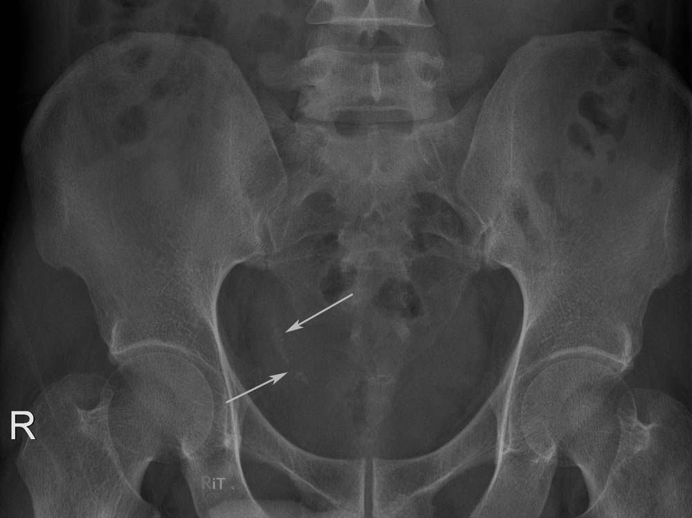 RiT radiology: Steinstrasse