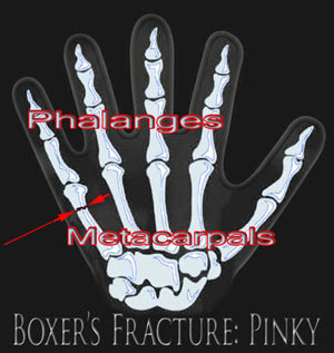 A Boxer's Fracture Tale: The Primer - Boxer's (Break) Fracture