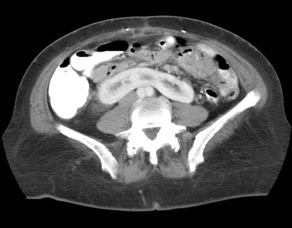 CT/USI: Horseshoe Kidney