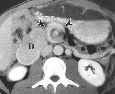 CT/USI: "Whirl Sign"