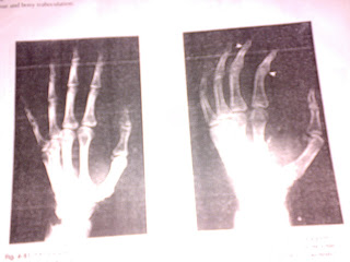 About Radiology: Teknik Radiografi Os Manus