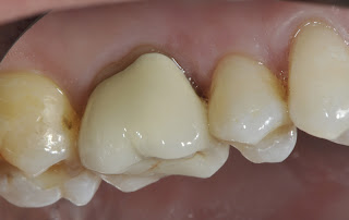 James Mahooti DDS: Tooth decay under crowns. What is leakage? How ...