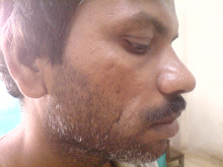 SURGEON'S WORLD: FAT ATROPHY