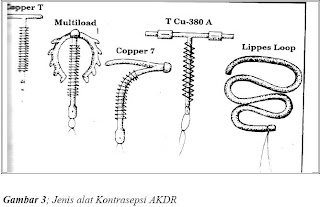 HEALTHY CAU'S: KONTRASEPSI IMFLAN/AKBK, IUD/AKDR, KONTAP