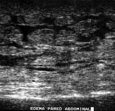 Edema Cronico de Pared Abdominal