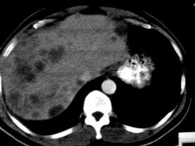 Metastasis Hepaticas