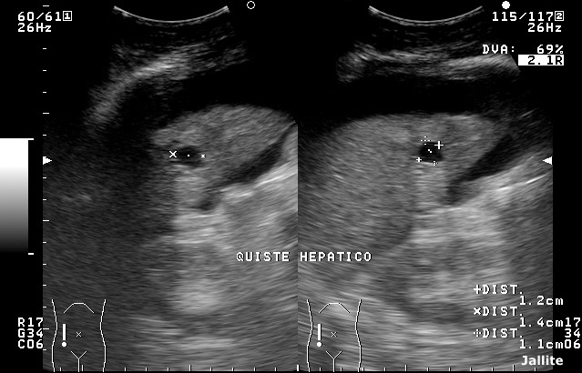Hemangioma & Quiste Hepatico