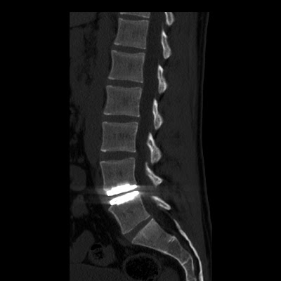 Medical Endeavors w/ my Herniated and Degenerative Lumbar Disc: CT-Scan ...