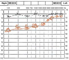 Bessie-bessi: Menieres sjukdom