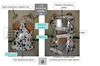 Brace technology: derotation brace