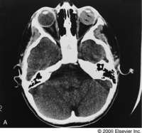 CT/MRI: Coats' Disease