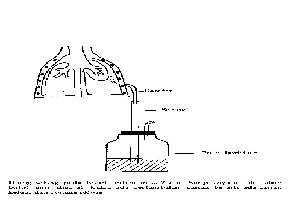 otoymarotoy: Catamenial Pneumothorax