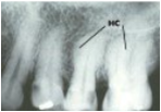 Periodoncia: CEMENTO RADICULAR