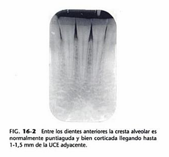 Periodoncia: HUESO ALVEOLAR