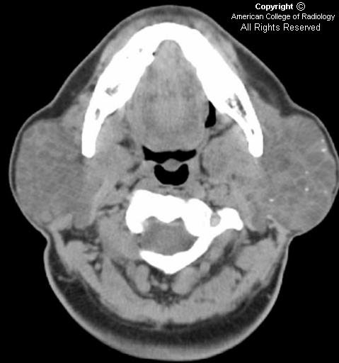Neuroradiology On the Net: Sjogren syndrome involving the parotid glands