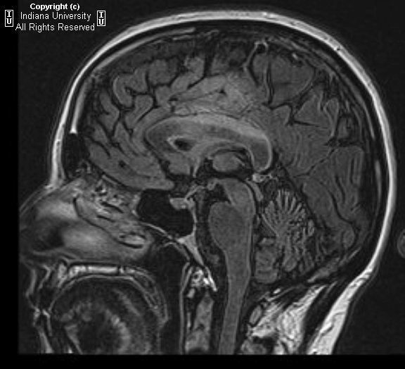 Neuroradiology On the Net: Acute disseminated encephalomyelitis (ADEM)