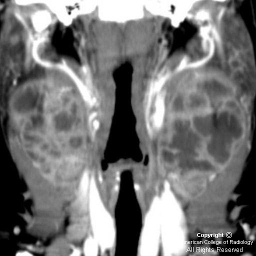 Neuroradiology On the Net: Scrofula
