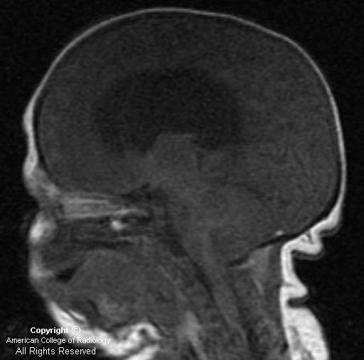 Neuroradiology On the Net: Chiari II Malformation