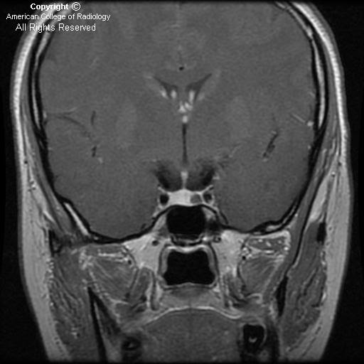Neuroradiology On the Net: Pituitary microadenoma