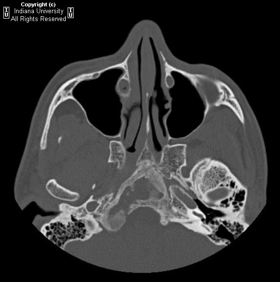 Neuroradiology On the Net: Monostotic clival fibrous dysplasia