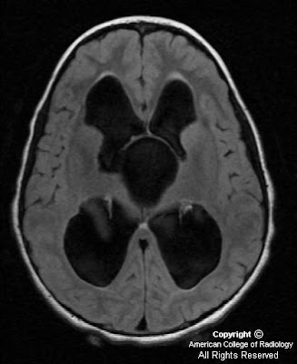 Neuroradiology On the Net: Suprasellar arachnoid cyst