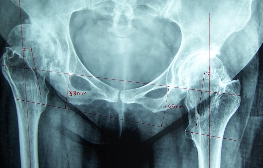 joint care foundation: Arthritic Hip Joint