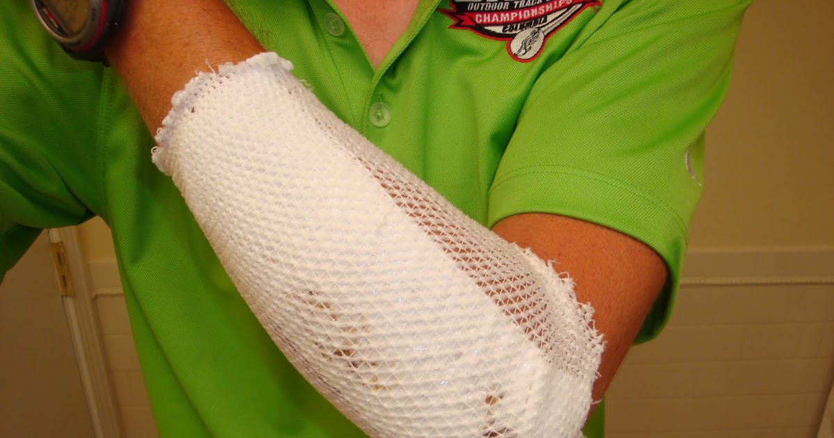 My World From a Bicycle: How to Treat and Care for Road Rash