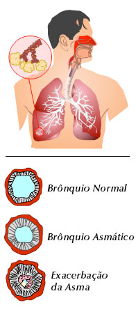 asma: Asma: O que é; O que desencadeia; Sintomas; Tenho asma; Como ...
