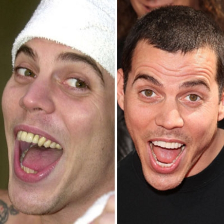 ToothTech: Bad Celebrity Smiles - Before and After