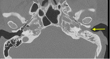 BLOG SCAN - RA Radiologistas Associados: COLESTEATOMA DA PARS TENSA