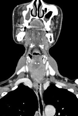 BLOG SCAN - RA Radiologistas Associados: TUMOR DE HIPOFARINGE E ESÔFAGO ...