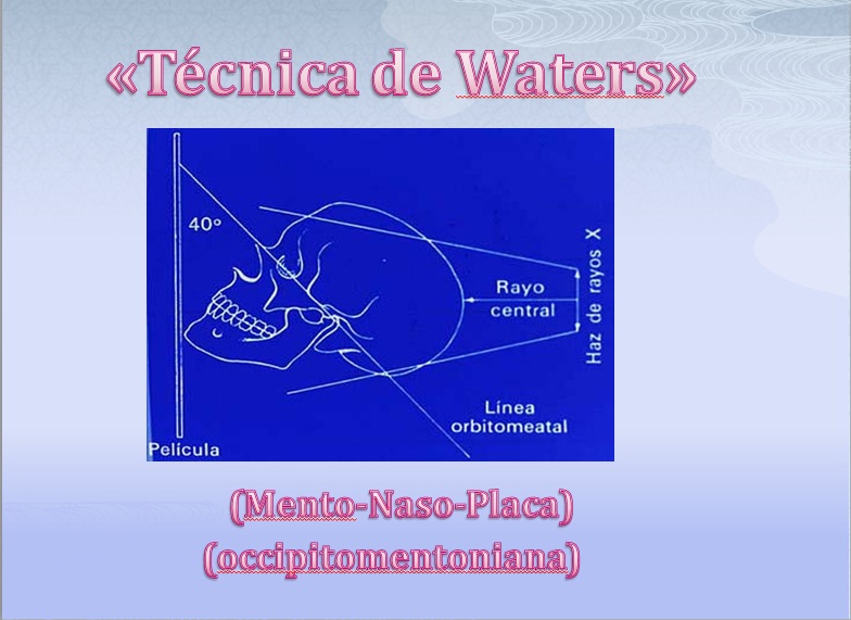 Odonto CICS: Tecnica de Waters