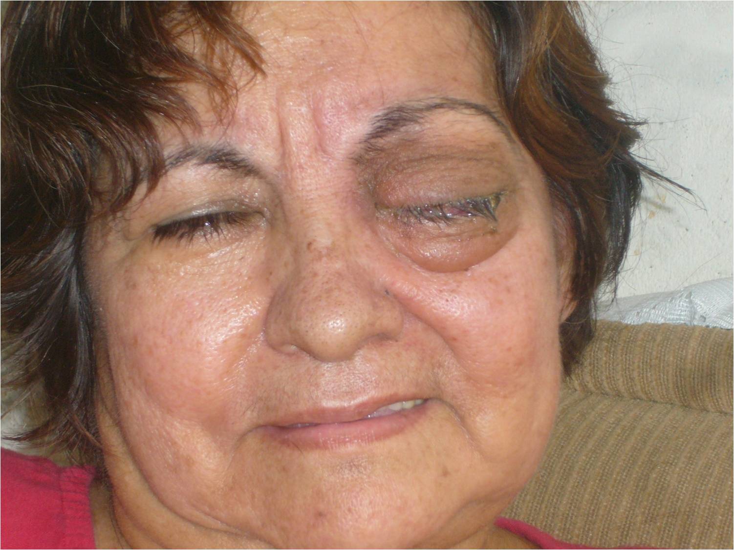 VIVE SALUDABLE.: Tumor en Ojo y pxp