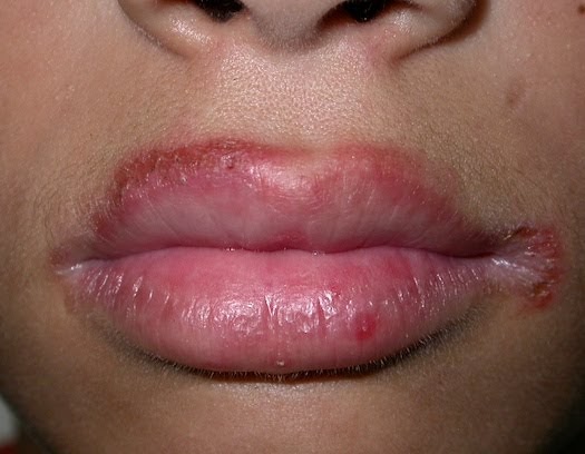 Dermatologia: Queilite e pasta de dente