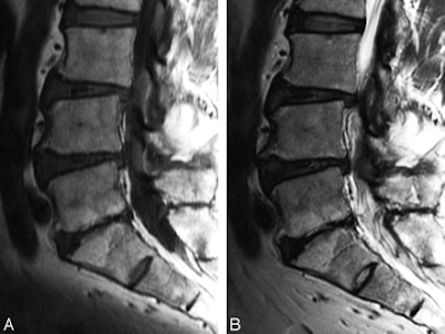 NEURORADIOLOGY: Classification of Modic endplate changes in ...