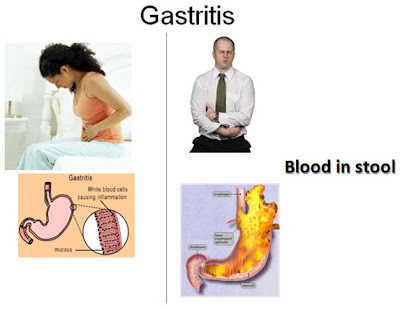 Digestive diseases | Science Department @ St. George's College