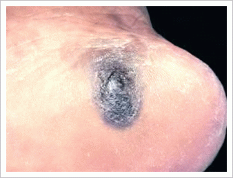 What is skin cancer?: What is Acral lentiginous melanoma