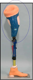 Shortened transfemoral prosthesis manufacturing: Custom-fit shortens ...