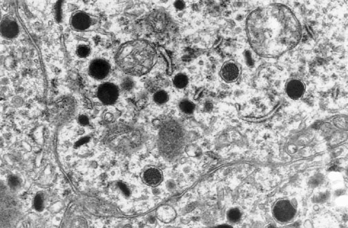 Historia do Feocromocitoma.: FEOCROMOCITOMA.